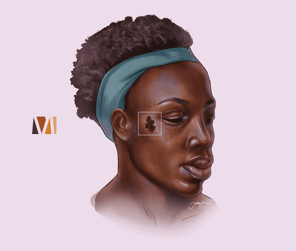 What is Melanoma? | Melalogic