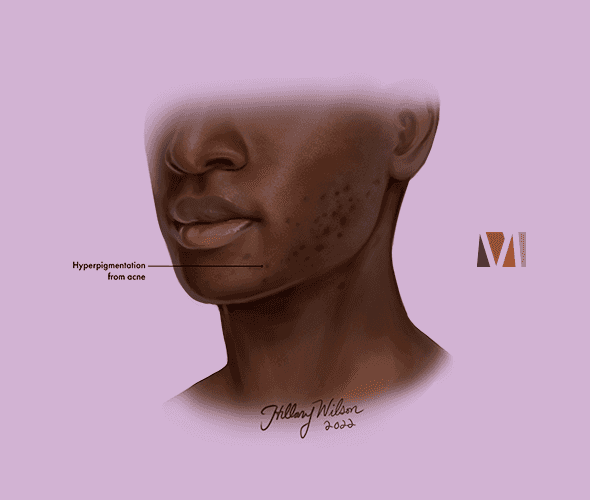 What Is Hyperpigmentation? | Melalogic